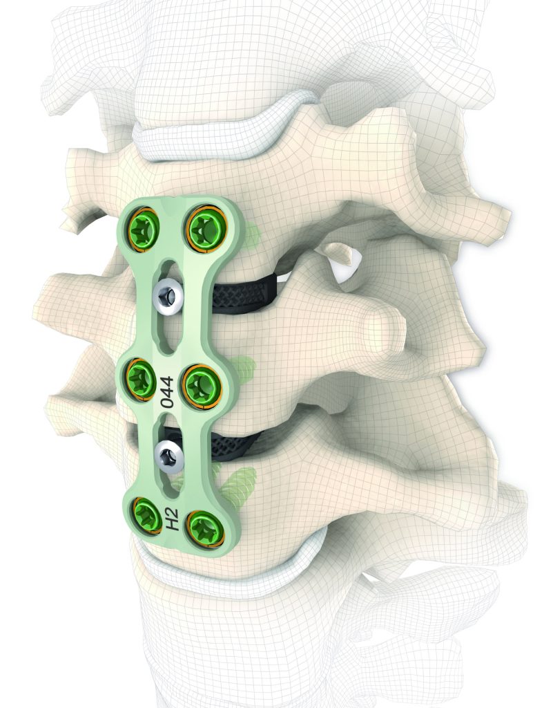 Intelligent design of the JASPIS® ST disc replacement implant from ...