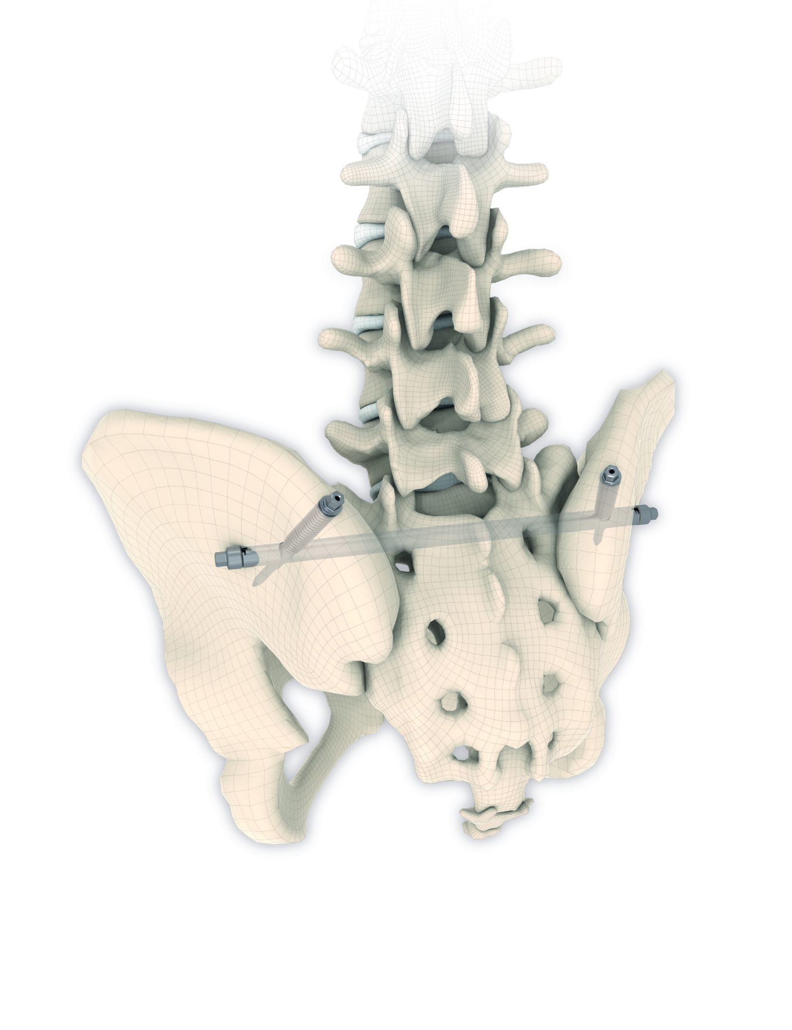 Introducing the SACRONAIL implant from Signus - Spinal Surgery News